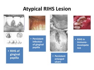Solitary oral ulcers and systemic diseases | PPTX