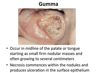 Solitary oral ulcers and systemic diseases | PPTX