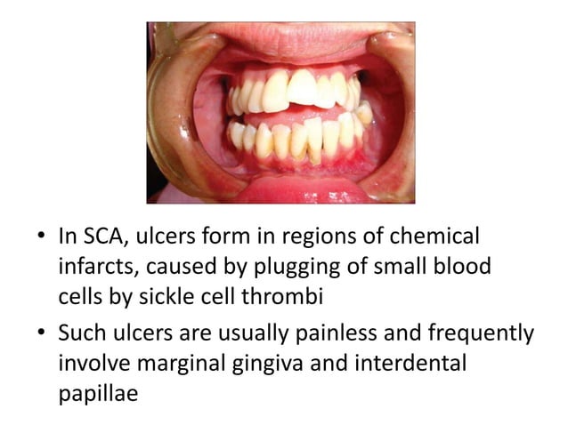 Solitary oral ulcers and systemic diseases | PPTX | Infectious Diseases ...