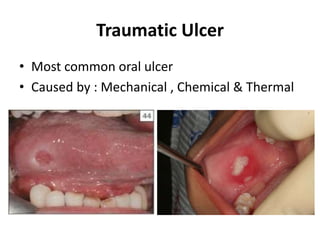 Solitary oral ulcers and systemic diseases | PPTX