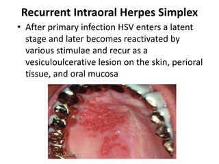 Solitary oral ulcers and systemic diseases | PPT
