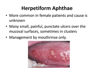 Solitary oral ulcers and systemic diseases | PPT