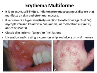 Solitary oral ulcers and systemic diseases | PPT