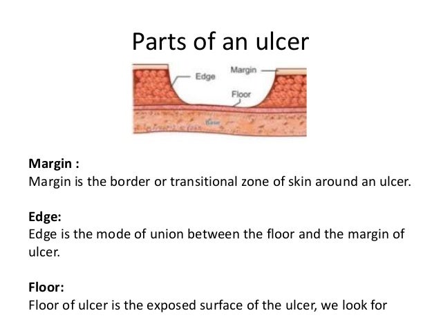 Solitary Oral Ulcers And Systemic Diseases