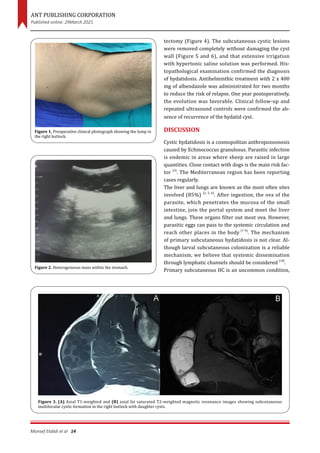 Solitary primary subcutaneous hydatid cyst of the buttock – case report ...