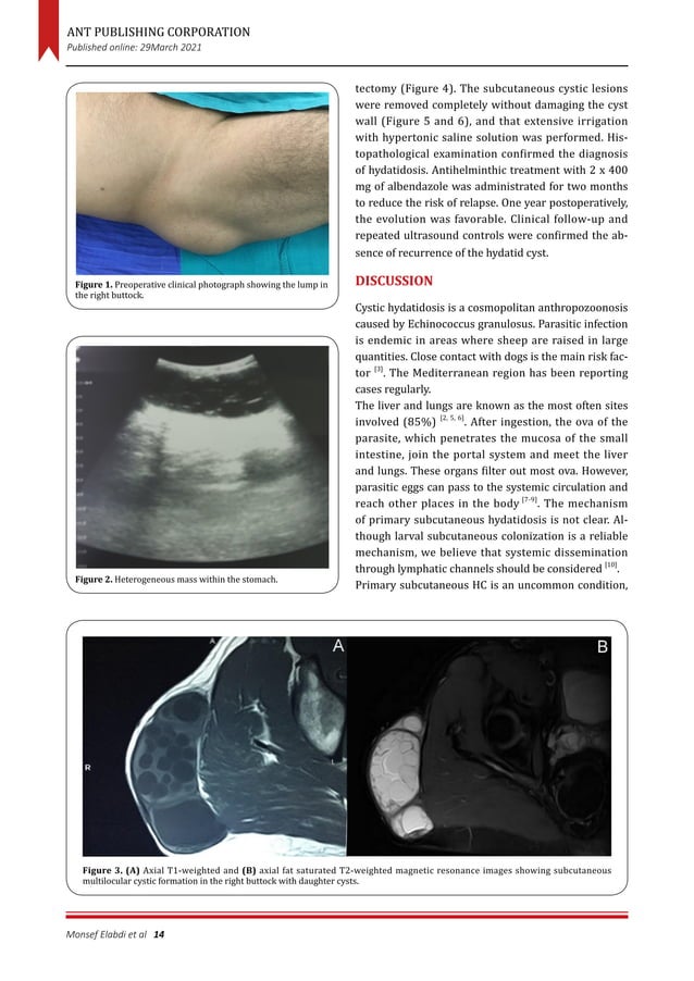 Solitary primary subcutaneous hydatid cyst of the buttock – case report ...