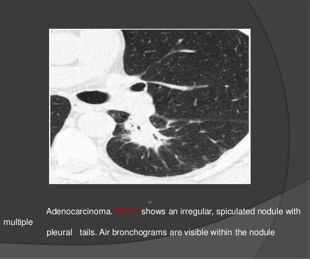 Solitary pulmonary nodule