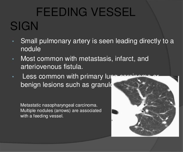 Solitary pulmonary nodule