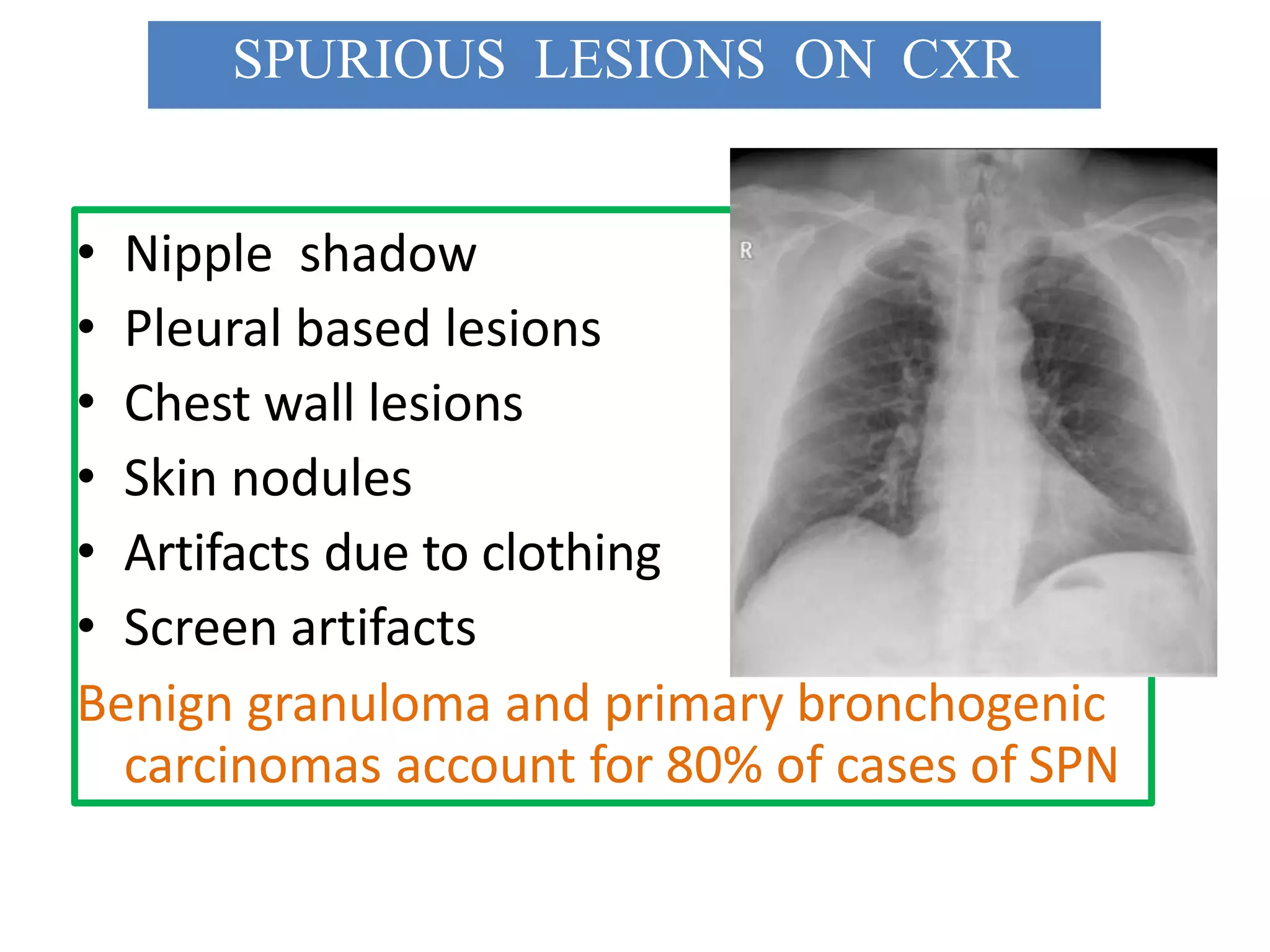 Know "Solitary Pulmonary Nodule" in a simple way !! (Radiology) | PPTX