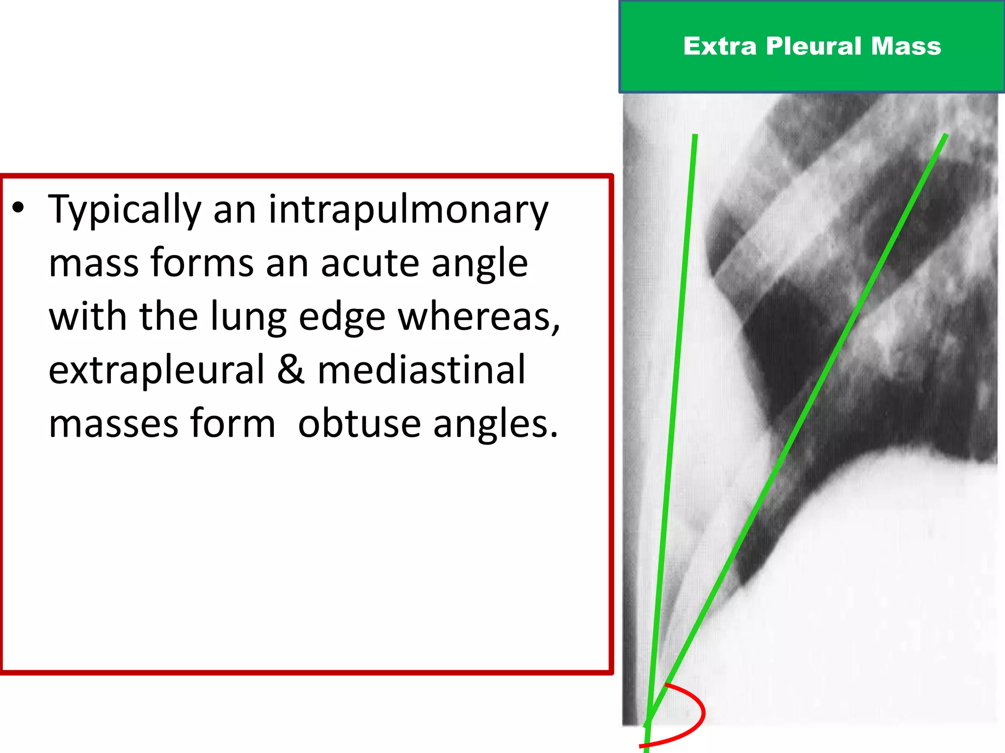 Know "Solitary Pulmonary Nodule" in a simple way !! (Radiology) | PPTX