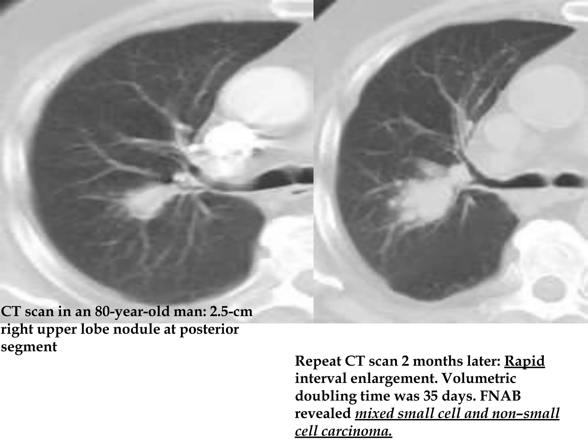 Know "Solitary Pulmonary Nodule" in a simple way !! (Radiology) | PPTX