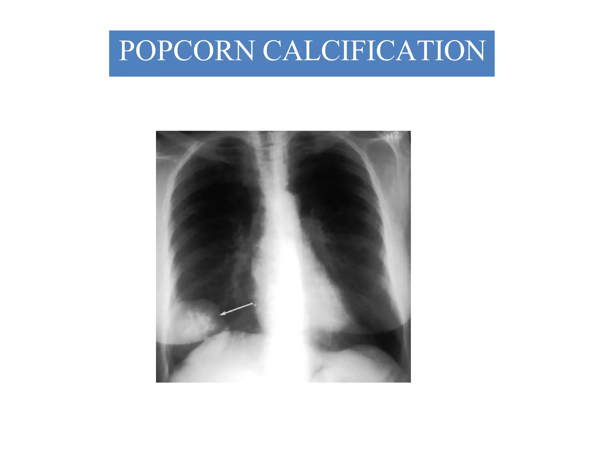Know "Solitary Pulmonary Nodule" in a simple way !! (Radiology) | PPTX