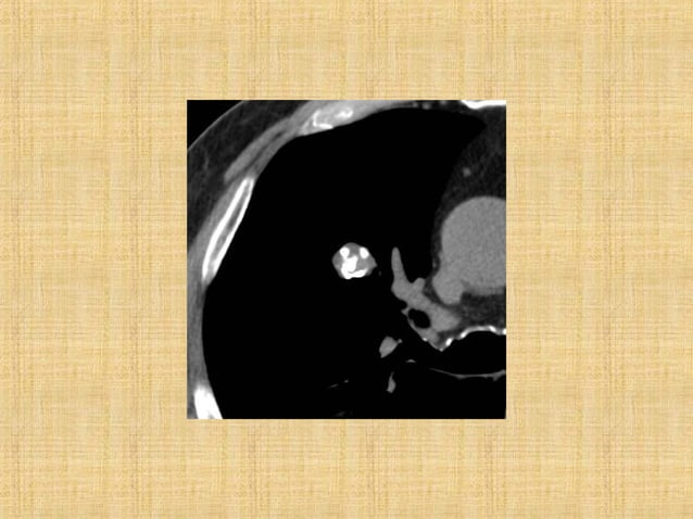Solitary Pulmonary Nodule Ppt