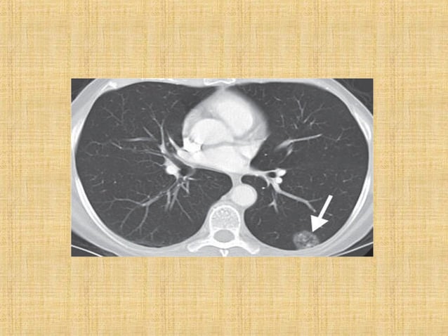 Solitary Pulmonary Nodule Ppt
