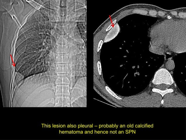 Solitary pulmonary nodule (SPN) | PPT