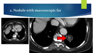 SOLITARY PULMONARY NODULE.pptx