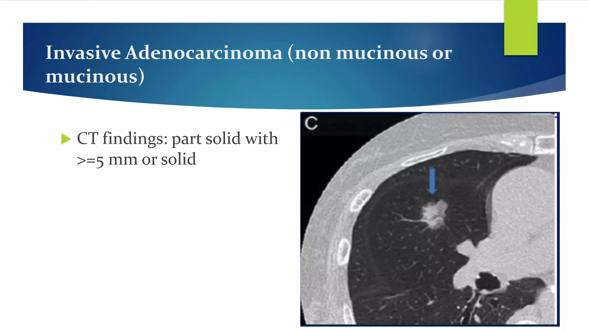 Solitary Pulmonary Nodule Pptx