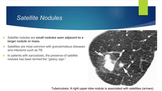 SOLITARY PULMONARY NODULE.pptx