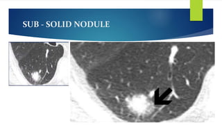SOLITARY PULMONARY NODULE.pptx