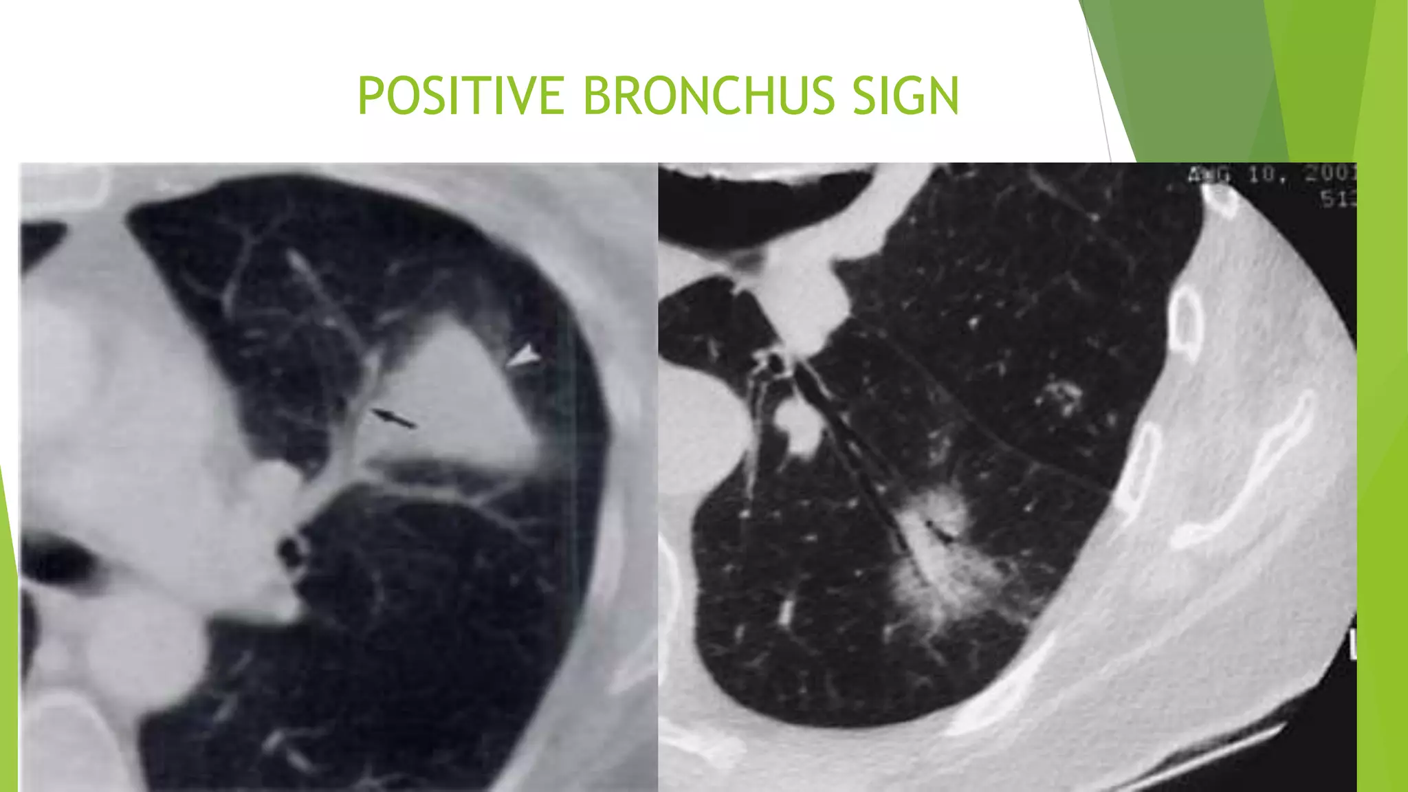 Solitary pulmonary nodules radiology pk ppt | PPTX