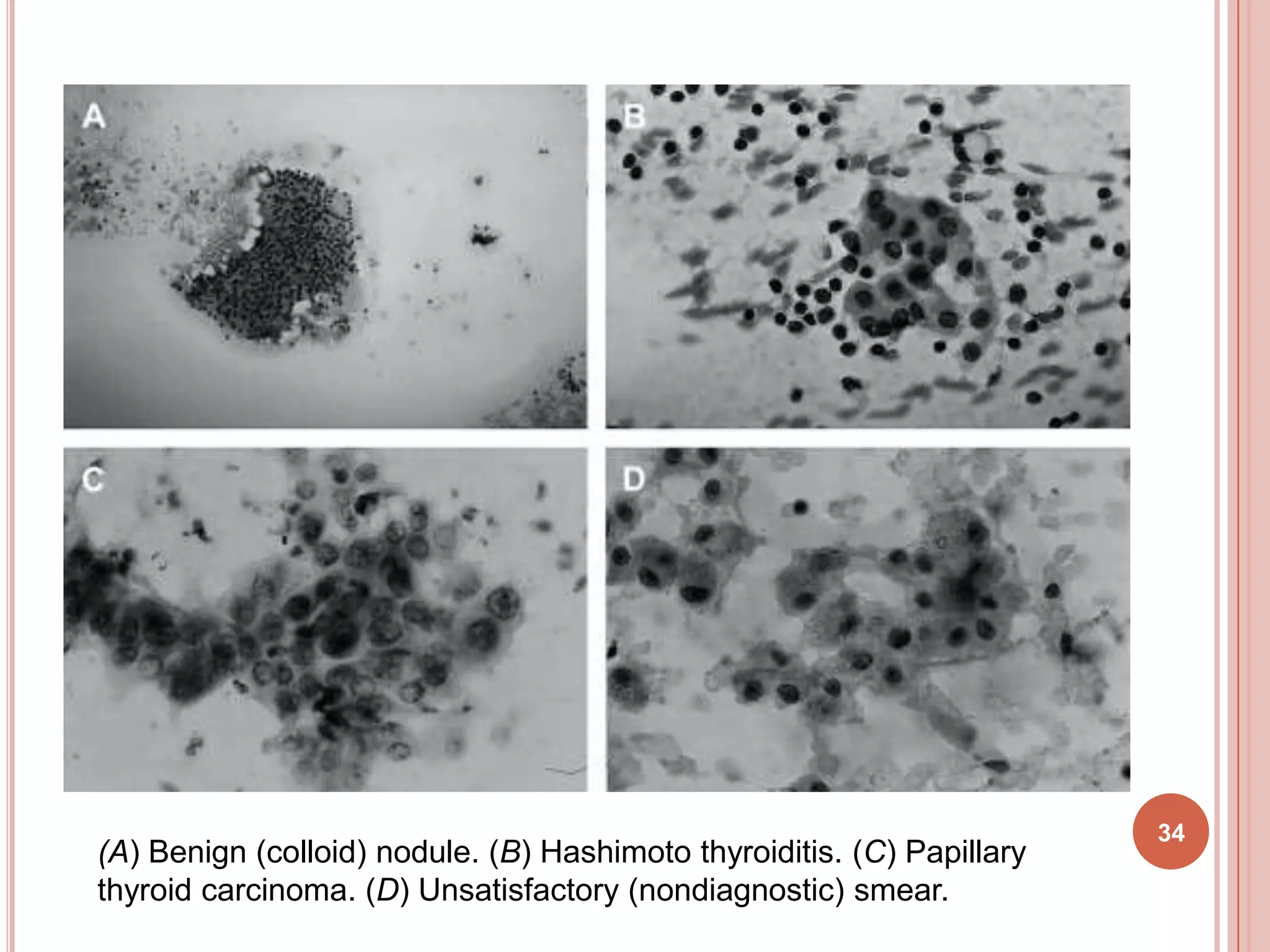 Solitary Thyroid Nodule | PPTX
