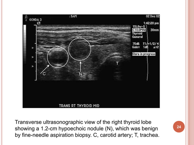 Solitary Thyroid Nodule Pptx Thyroid Disorders Endocrine And Metabolic Diseases