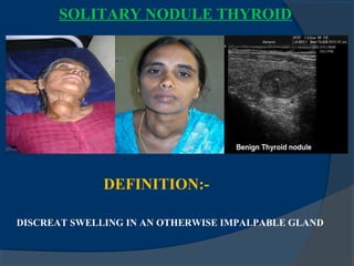 Solitary thyroid nodule | PPT