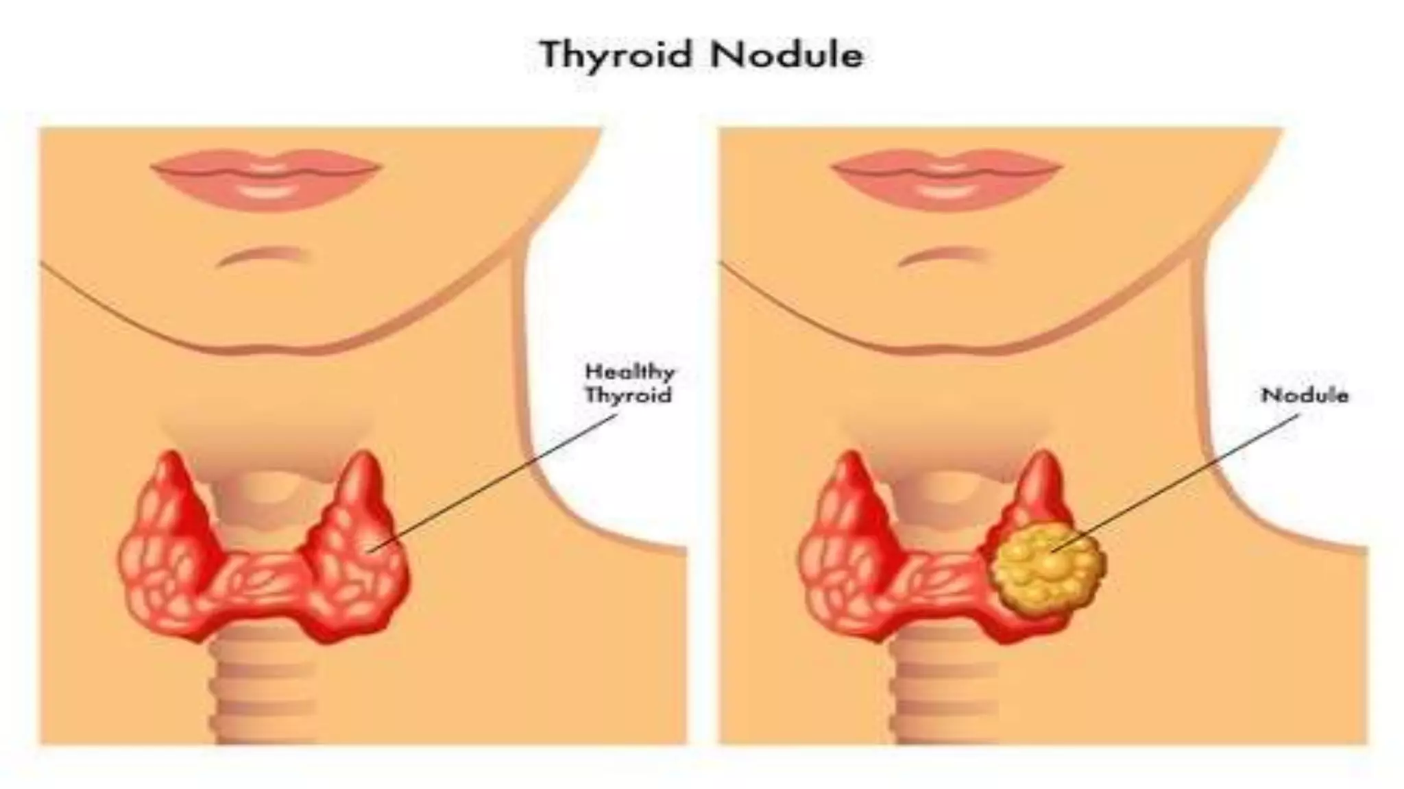 Solitary Thyroid Nodule Pptx