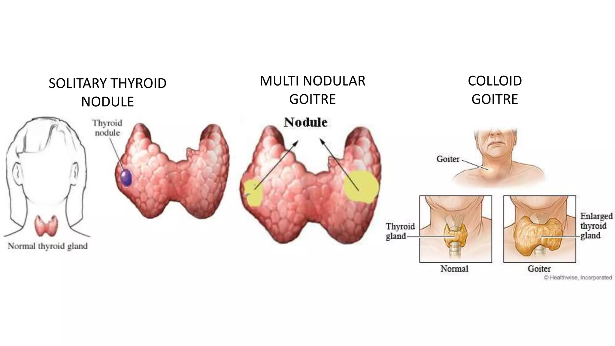 Solitary thyroid nodule | PPTX