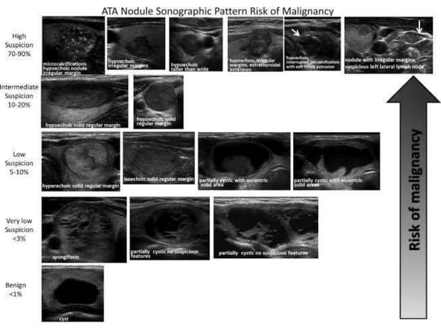 Solitary Thyroid Nodule Pptx