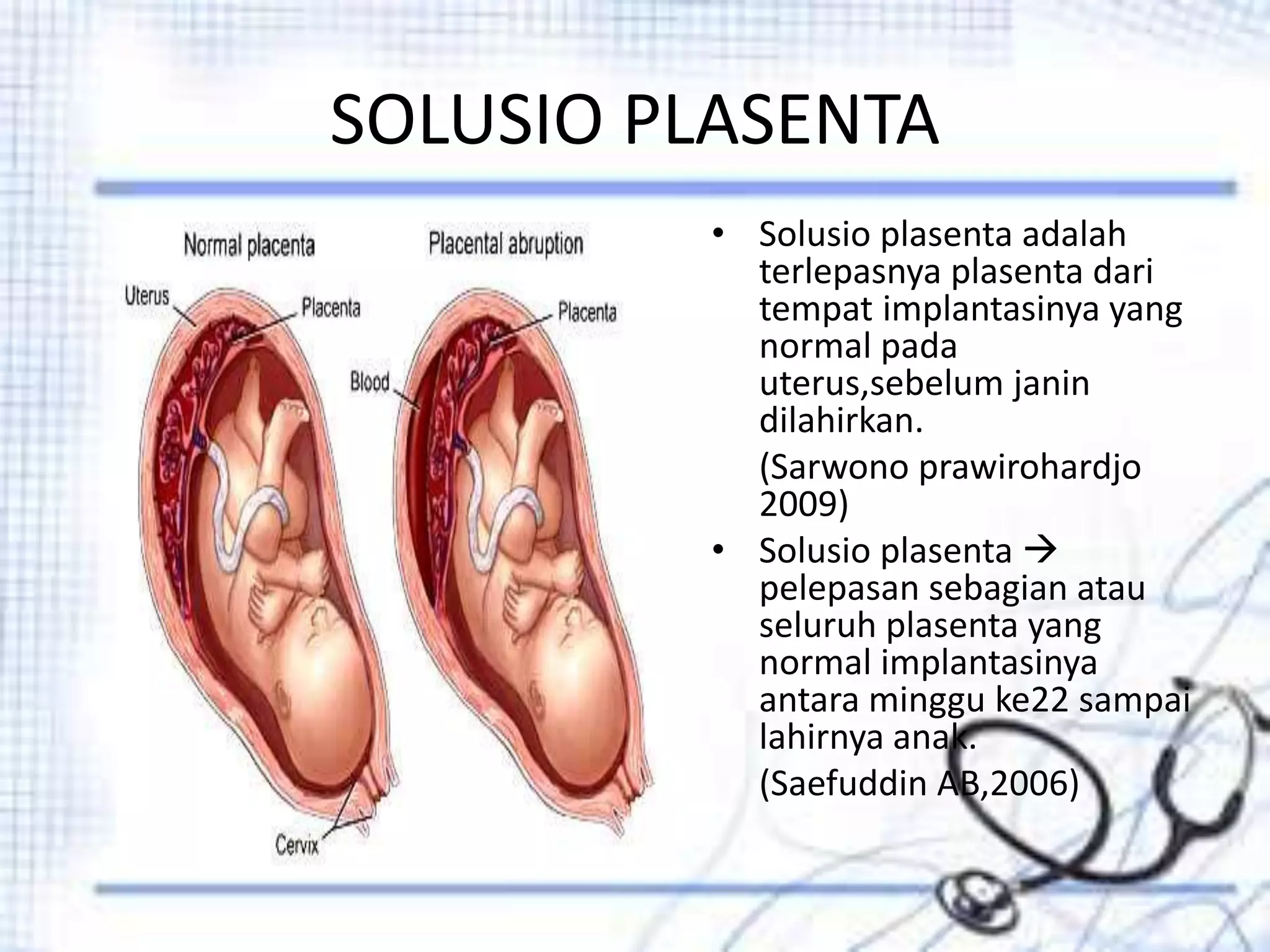 Solusio placenta | PPTX