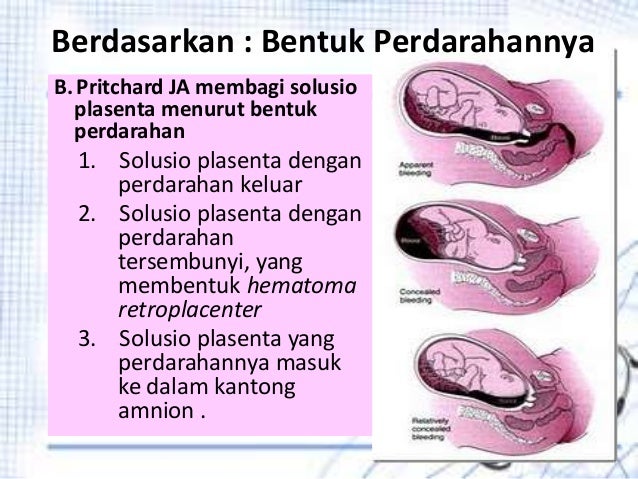 Solusio placenta