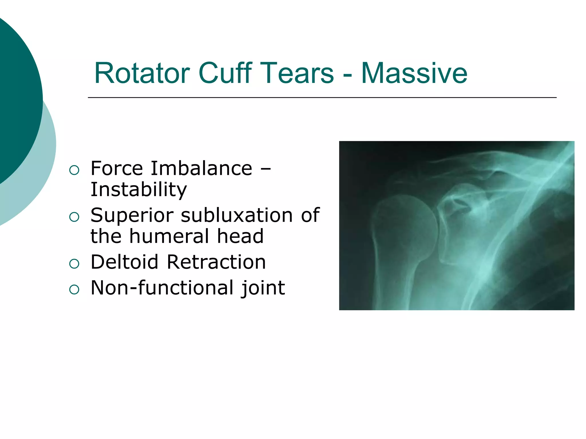 Solution to Rotator Cuff Deficient Shoulder.ppt