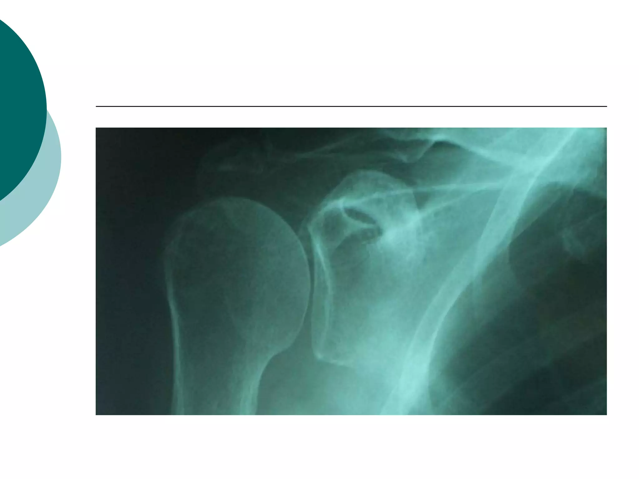 Solution to Rotator Cuff Deficient Shoulder.ppt