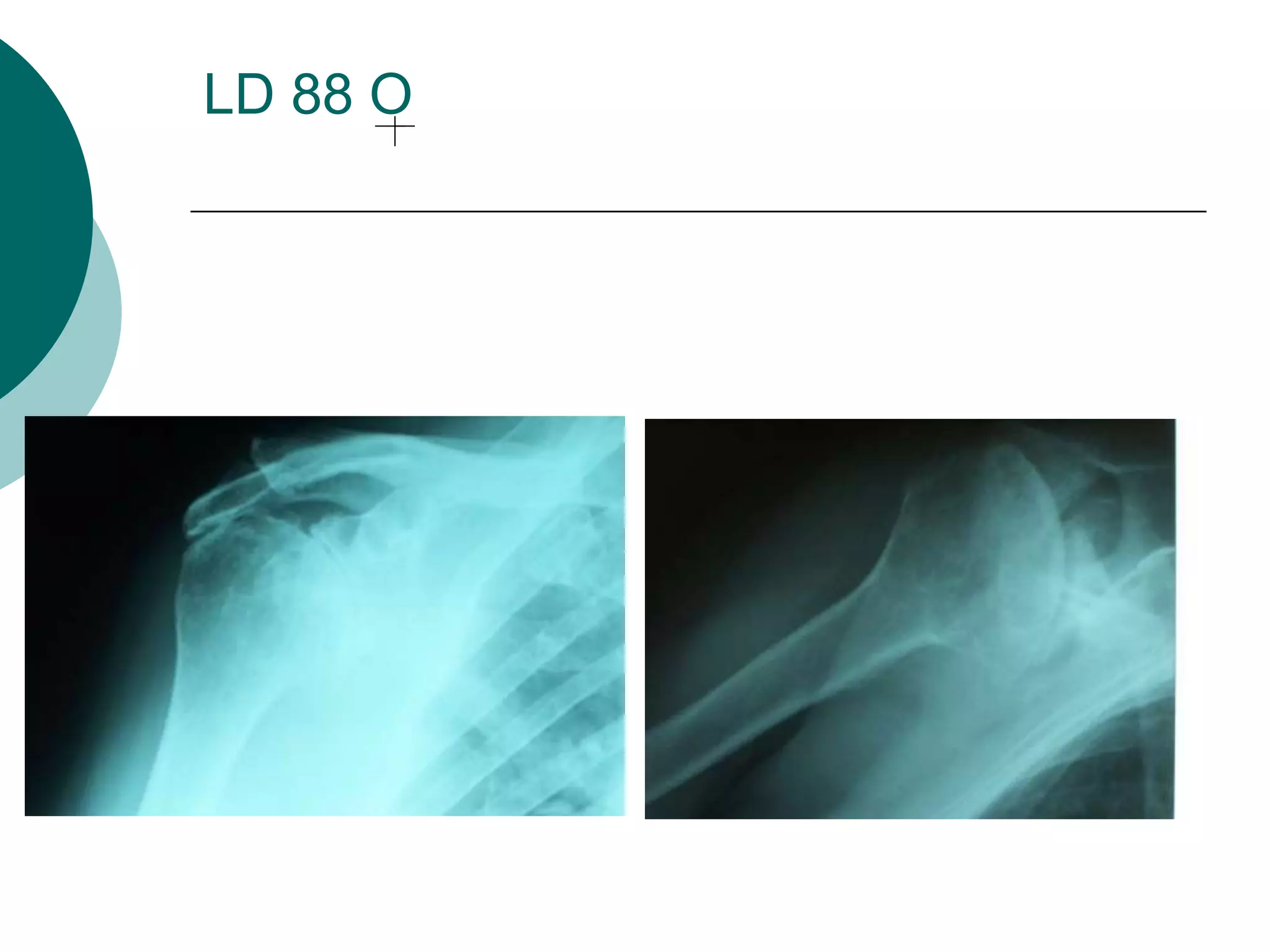 Solution to Rotator Cuff Deficient Shoulder.ppt