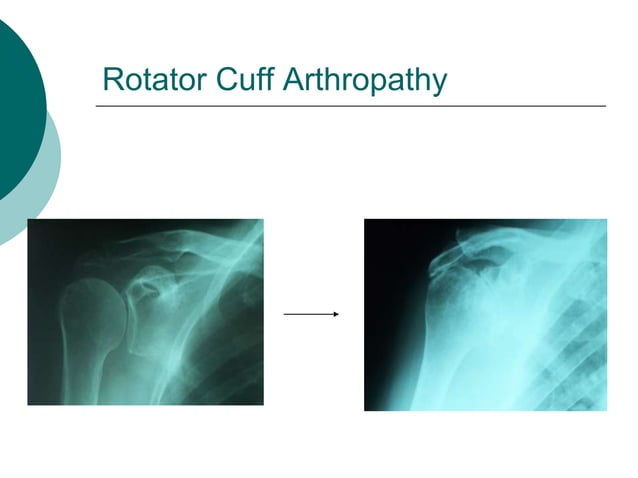 Solution to Rotator Cuff Deficient Shoulder.ppt