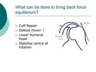 Solution to Rotator Cuff Deficient Shoulder.ppt