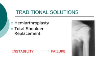 Solution to Rotator Cuff Deficient Shoulder.ppt