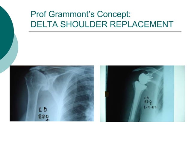 Solution to Rotator Cuff Deficient Shoulder.ppt