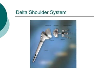 Solution to Rotator Cuff Deficient Shoulder.ppt