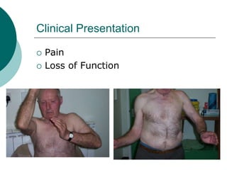 Solution to Rotator Cuff Deficient Shoulder.ppt