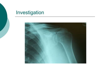 Solution to Rotator Cuff Deficient Shoulder.ppt