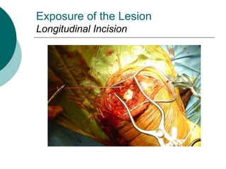 Solution to Rotator Cuff Deficient Shoulder.ppt