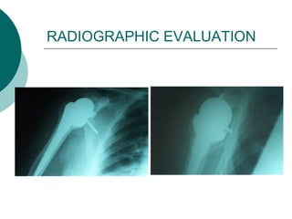 Solution to Rotator Cuff Deficient Shoulder.ppt