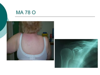 Solution to Rotator Cuff Deficient Shoulder.ppt