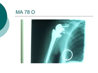 Solution to Rotator Cuff Deficient Shoulder.ppt