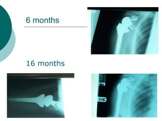 Solution to Rotator Cuff Deficient Shoulder.ppt