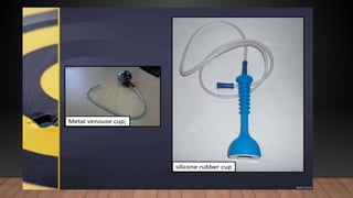 SOLWEZI GENERAL HOSPITAL assisted vaginal delivery.pdf