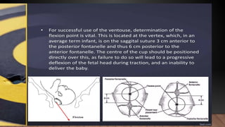 SOLWEZI GENERAL HOSPITAL assisted vaginal delivery.pdf