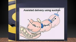 SOLWEZI GENERAL HOSPITAL assisted vaginal delivery.pdf